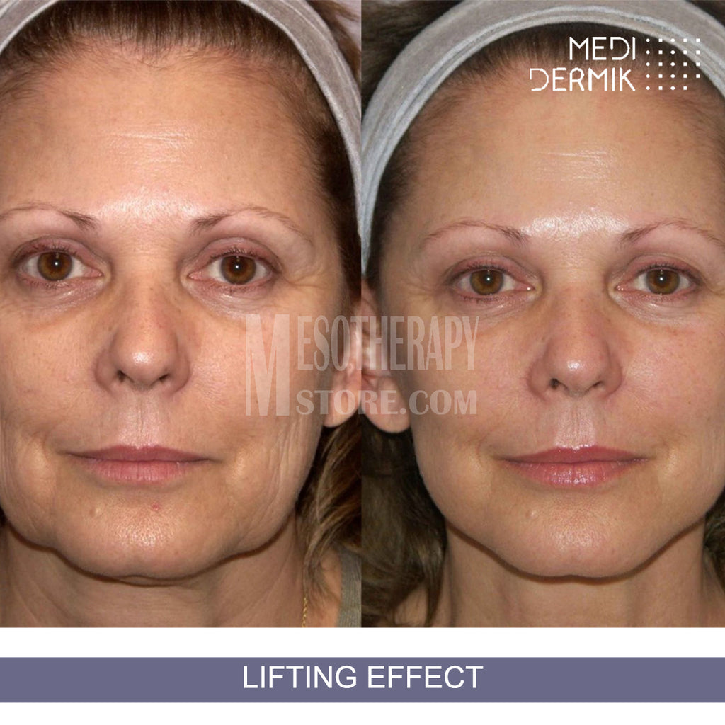 Flaccidity Treatment By Medidermik Mesotherapy - Mesoterapia